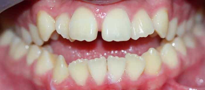 Smile Gallery | TLC Pediatric Dentistry & Orthodontics & Orthodontics ...